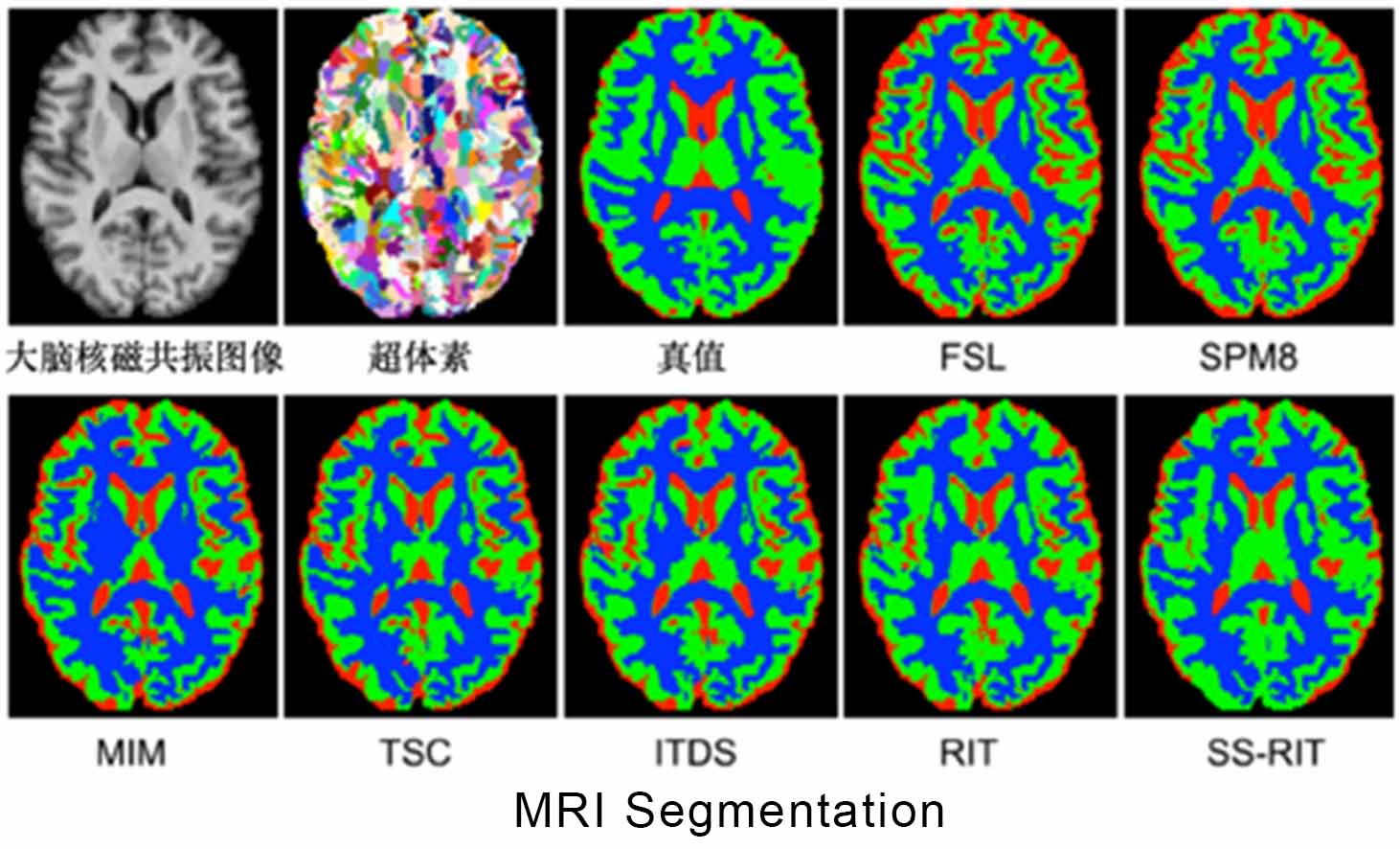 Brain Magnetic Resonance Image (MRI) Segmentation-LImIT Tsinghua University